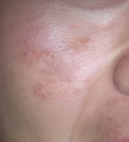 Facial Skin Object Detection Dataset by phamphong