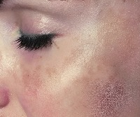 Facial Skin Object Detection Dataset by phamphong