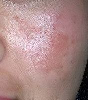 Facial Skin Object Detection Dataset by phamphong