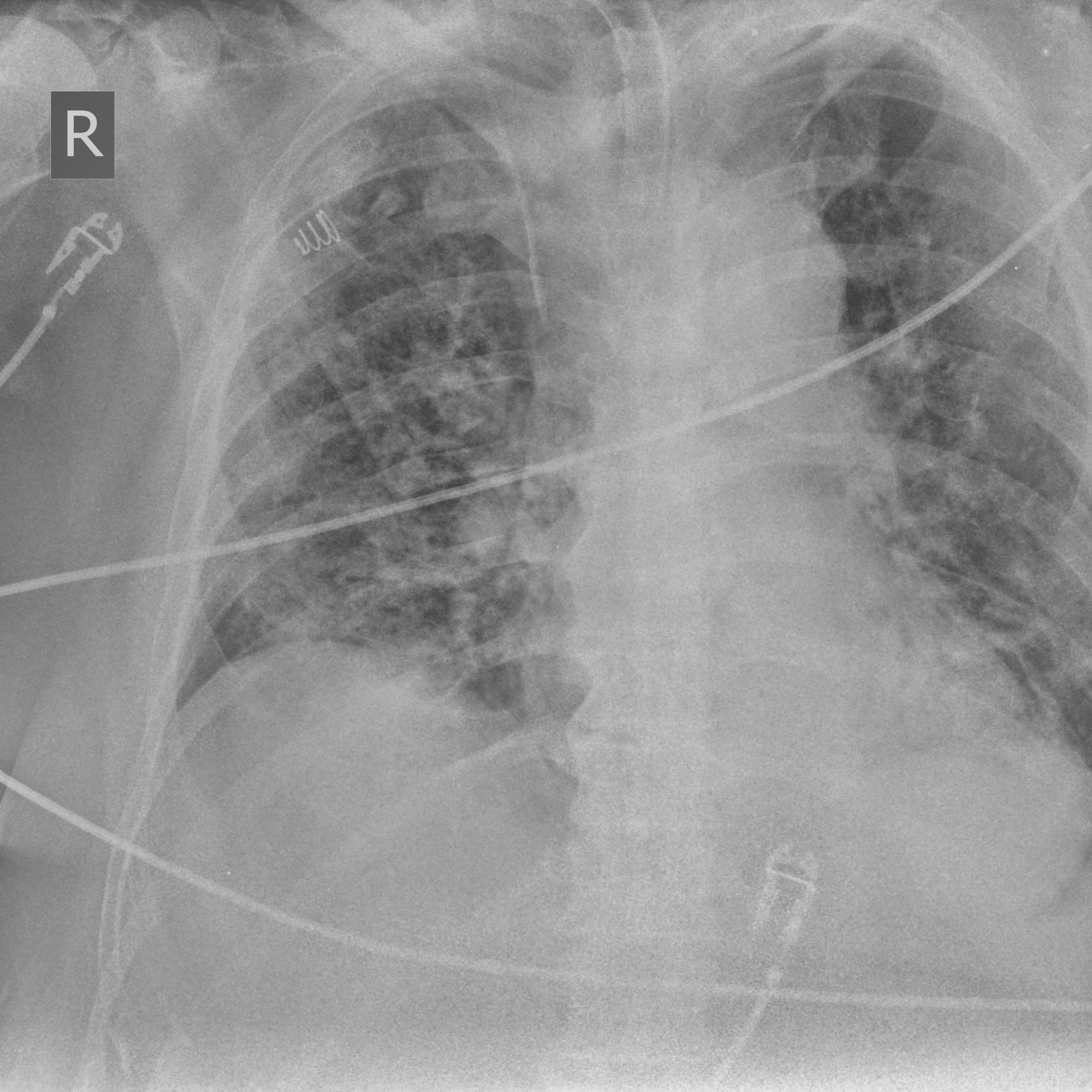 Chest X-ray(covid19 prediction) Object Detection Dataset by tru projects