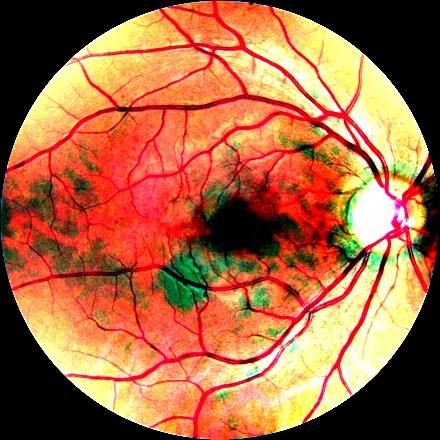 detection of eye Object Detection Dataset and Pre-Trained Model by dr ...