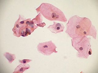 Pap Smear - Cancer Detection Object Detection Dataset by Cancer Anotation