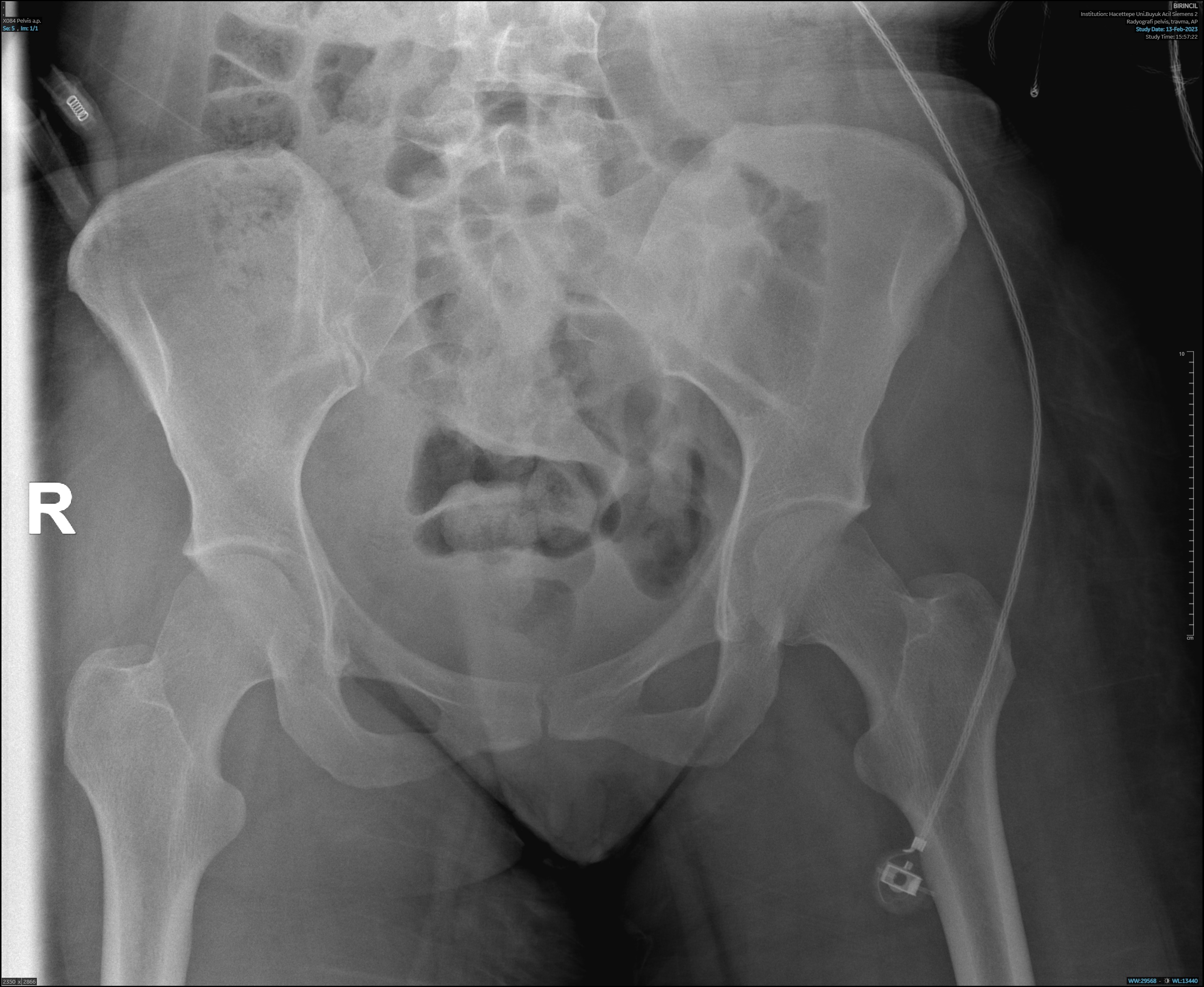 How to Use the pelvis detection Object Detection API