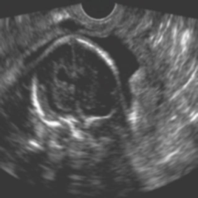 class:mild-ventriculomegaly | Roboflow Universe Search