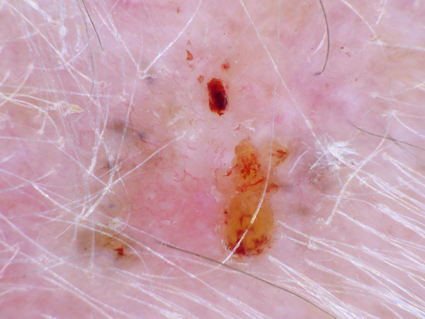 Basal Cell Carcinoma Object Detection Dataset V1 376 By Ai Prj
