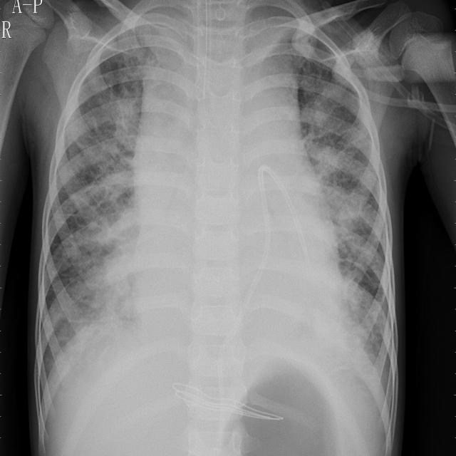 Pneumonia_Detection Classification Dataset and Pre-Trained Model by ...