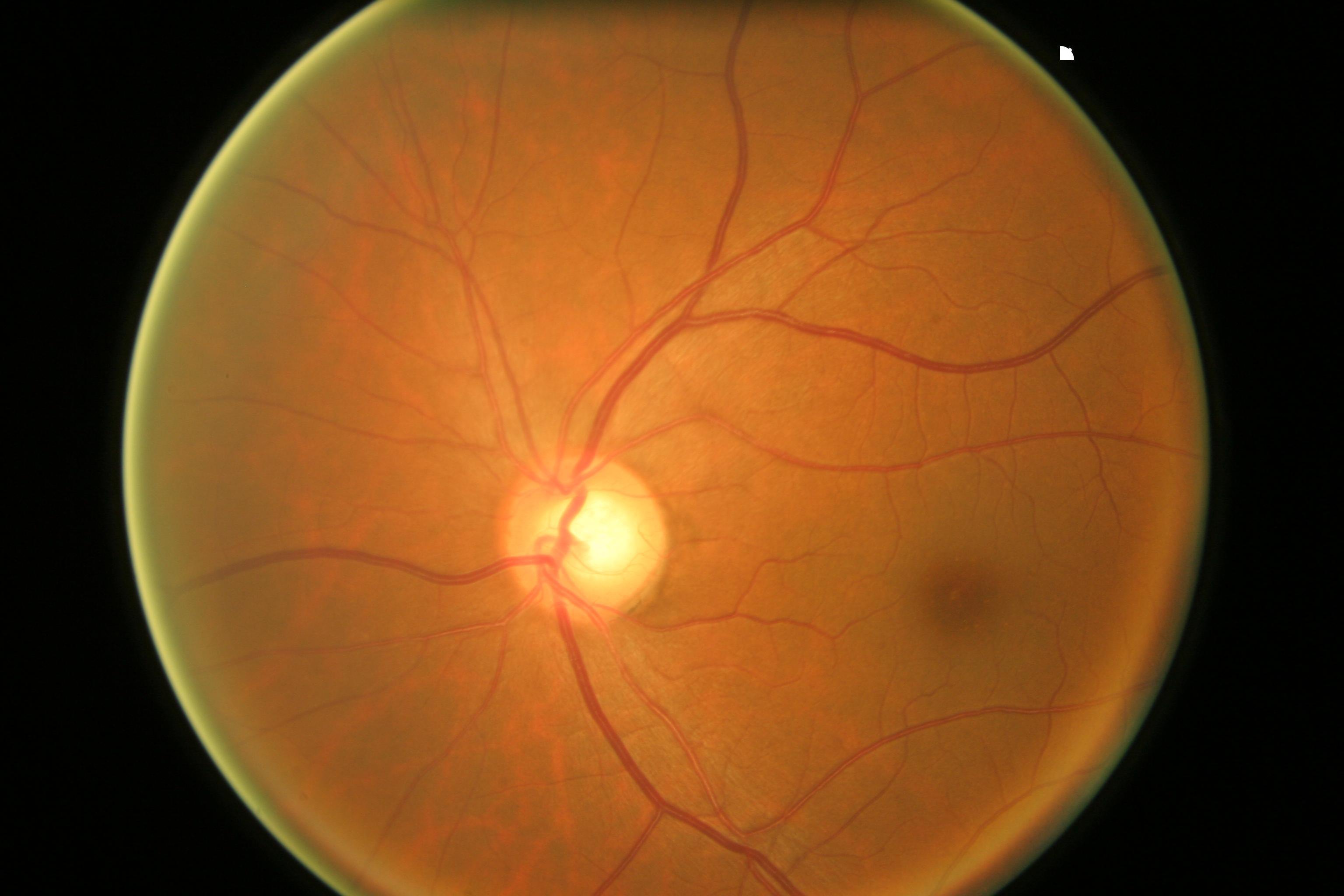 ORIGA_300 Instance Segmentation Dataset by DiscoOptico
