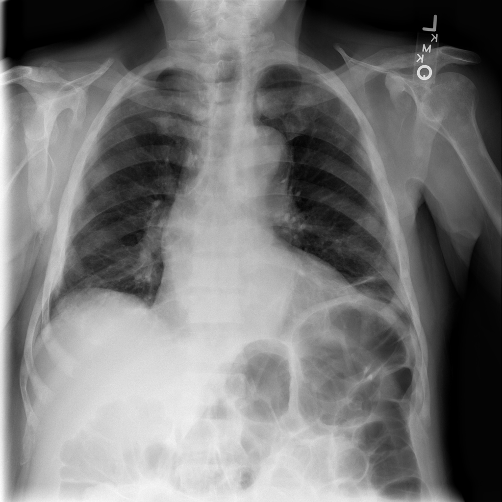 Xray Object Detection Dataset By Chestx