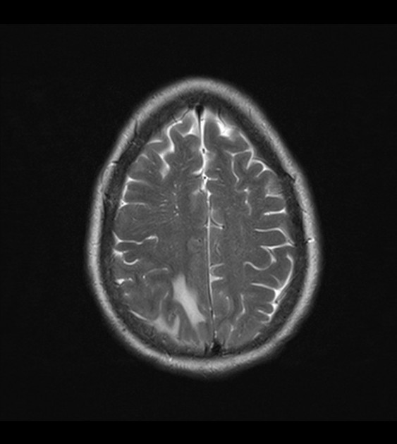 Brain Tumor MRI Classifications Classification Dataset and Pre-Trained ...
