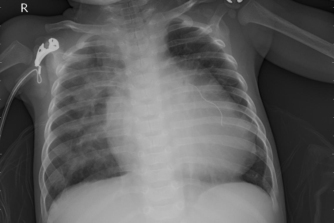 Pneumonia Classification Dataset and Pre-Trained Model by Erik Sörqvist