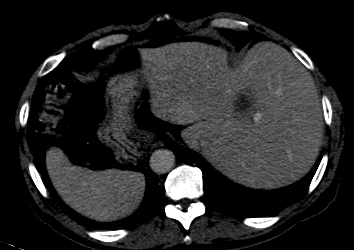 Liver Tumor detection Object Detection Dataset by projects