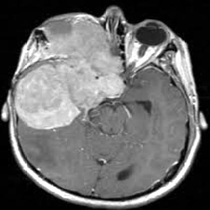 Brain tumor detector Object Detection Dataset and Pre-Trained Model by ...