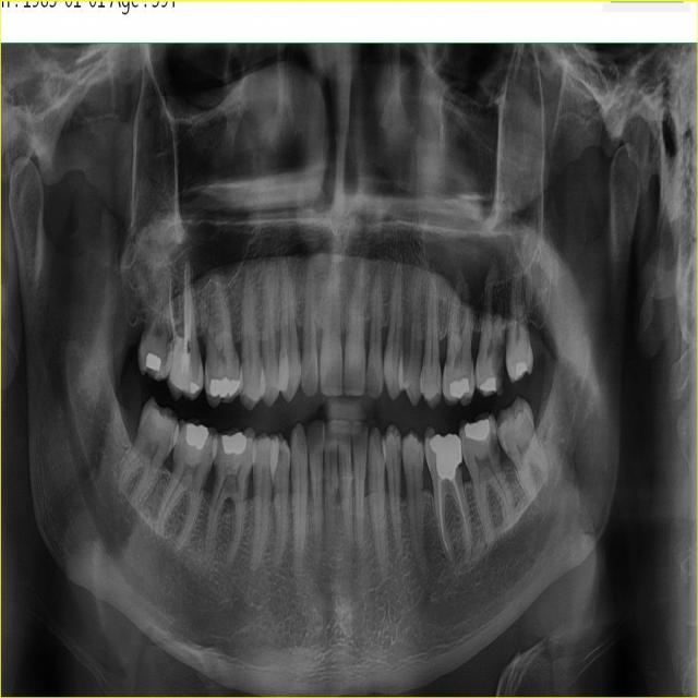 dental-caries Object Detection Dataset and Pre-Trained Model by magical
