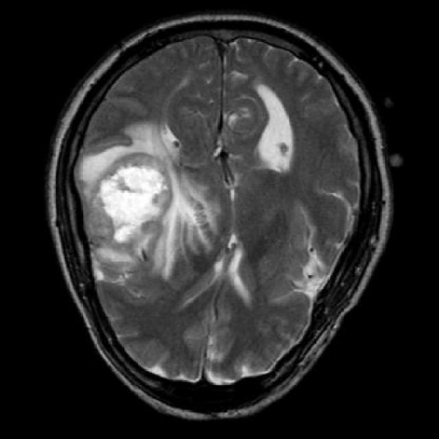 Mri Object Detection Dataset By Brain Mri