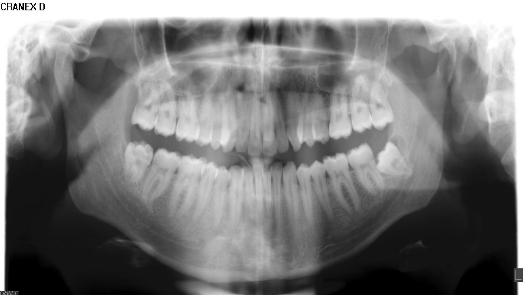 Teeth Object Dection Computer Vision Dataset By Gbc