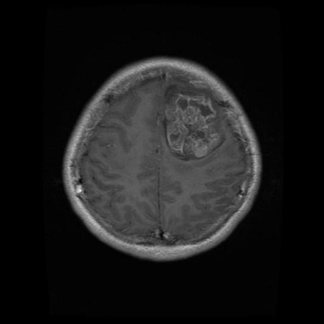 3 Types Tumor Detection Object Detection Dataset And Pre Trained Model