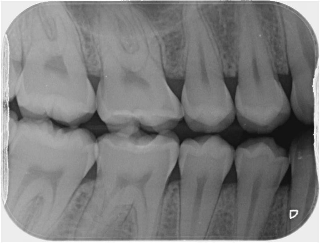 Bitewing_sag_aug_test Object Detection Dataset by Craoni