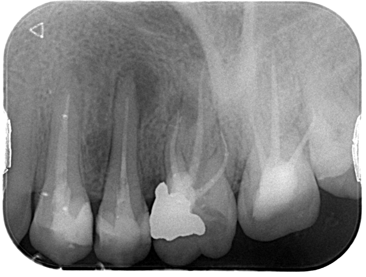periapical_lesion Object Detection Dataset by Craoni