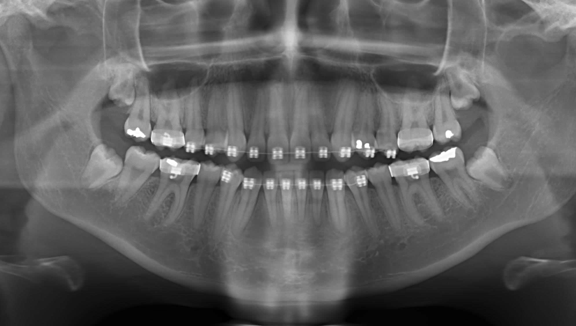 Dentition One Quadrant Object Detection Dataset by Dental Unique Features from Panoramic Radiography