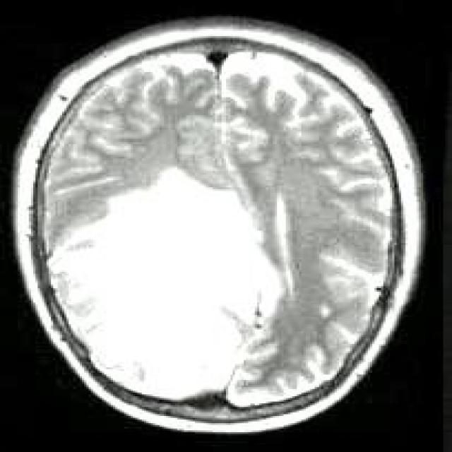 Mri Tumor Detection2 Instance Segmentation Dataset And Pre Trained
