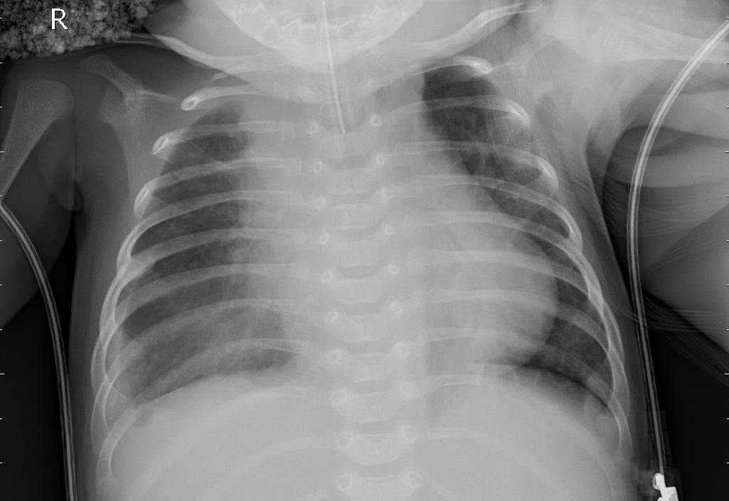 binary obj detection brain and pneumonia - Roboflow Universe