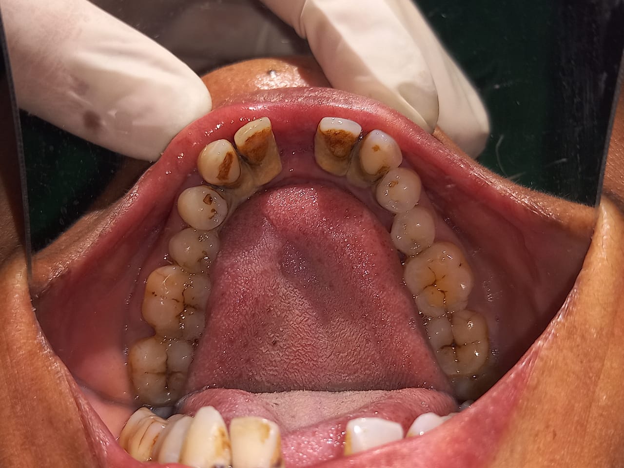 Caries Object Detection Dataset by BETiC