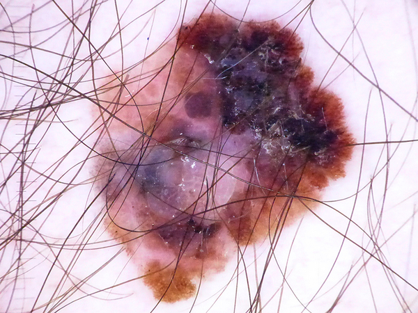 Skin-Cancer Object Detection Dataset and Pre-Trained Model by Emnnn