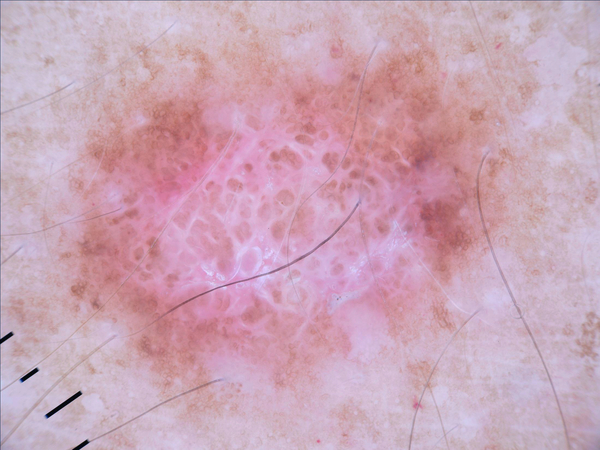 Skin-Cancer-Dermatofibroma Object Detection Dataset by Emnnn