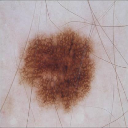 skin cancer Classification Dataset and Pre-Trained Model by University ...