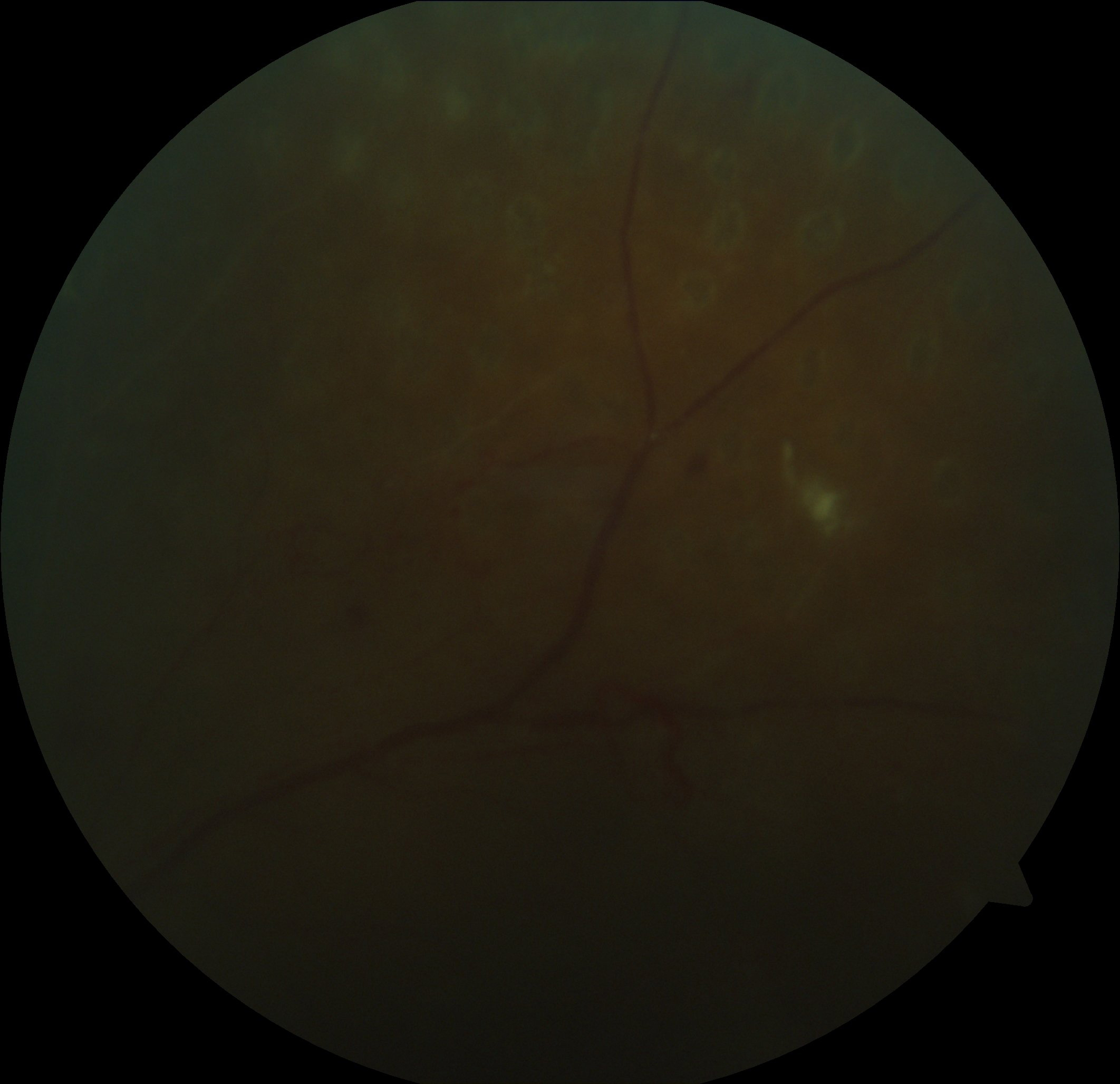diabetic retinopathy detection Object Detection Dataset and Pre-Trained ...