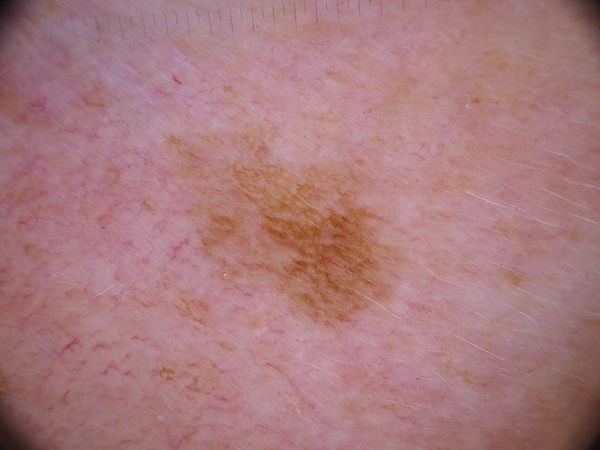 Skin-Disease-Four Classification Dataset by LUMS