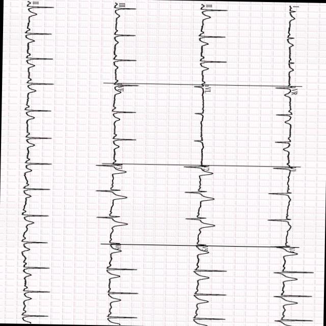 ECG Classification Dataset and Pre-Trained Model by deep learning