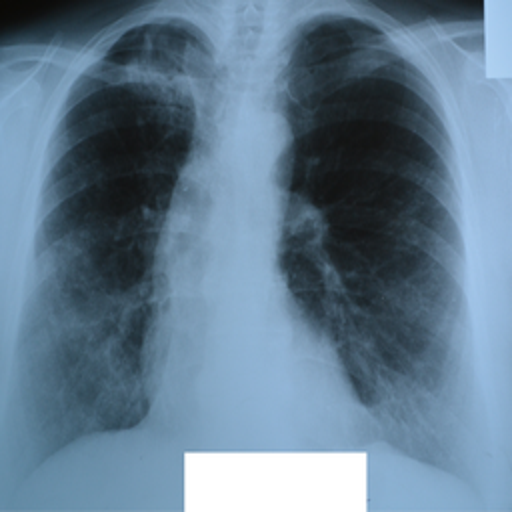 diease dection Classification Dataset and Pre-Trained Model by python stuff