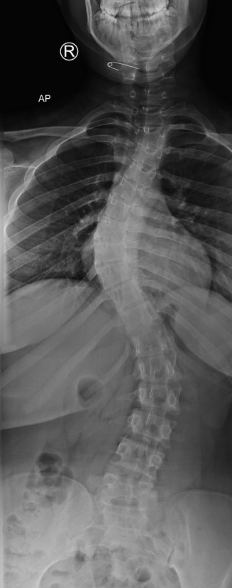 Spine Region Object Detection Dataset and Pre-Trained Model by CADMA