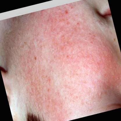 Face Diseases Detection Classification Dataset and Pre-Trained Model by ...