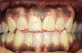 Smoker Melanosis Object Detection Dataset and Pre-Trained Model by Makhluk