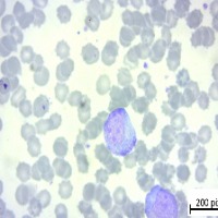 Leukemia Cancer Detection Object Detection Dataset and Pre-Trained ...