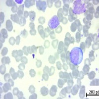 Leukemia Cancer Detection Object Detection Dataset and Pre-Trained ...