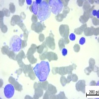 Leukemia Cancer Detection Object Detection Dataset and Pre-Trained ...