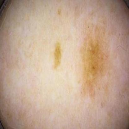 Skin Cancer Detection Object Detection Dataset by custom yolov5