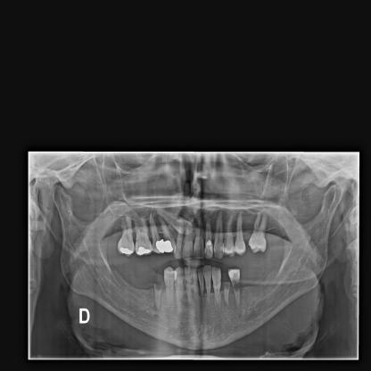 DENTS Object Detection Dataset and Pre-Trained Model by classe