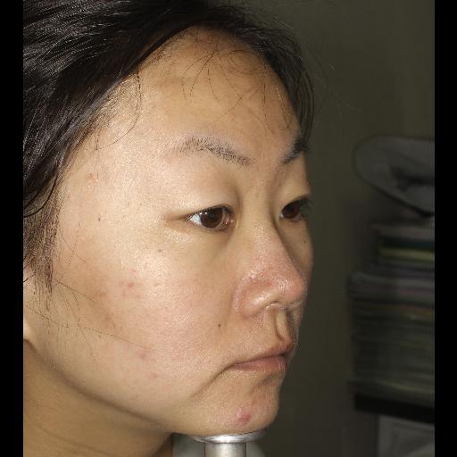 Acne New Data Object Detection Dataset By Dataset