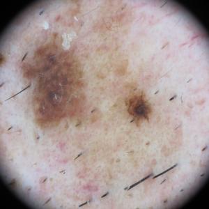 skin cancer class Object Detection Dataset by maciej