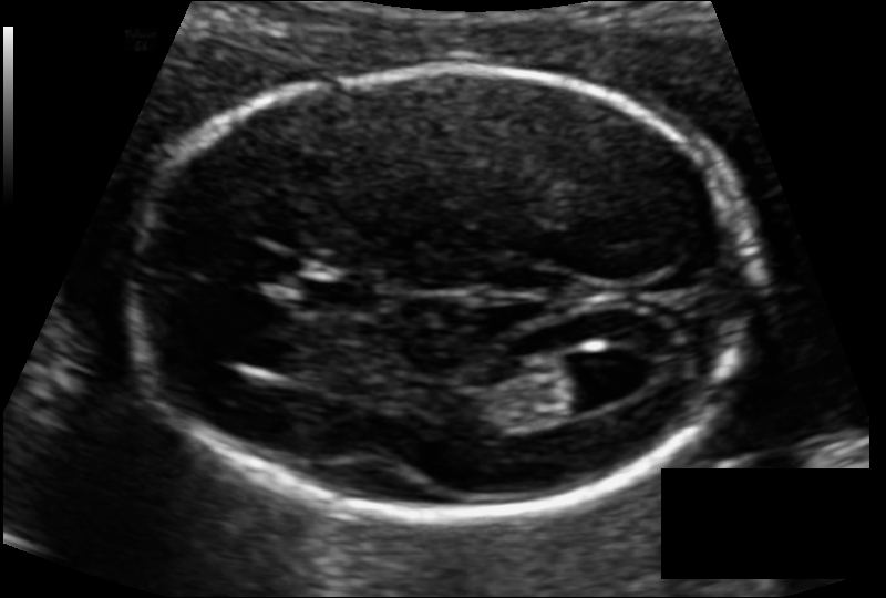 Ultrasound Fetal Brain Image Detection Object Detection Dataset And Pre