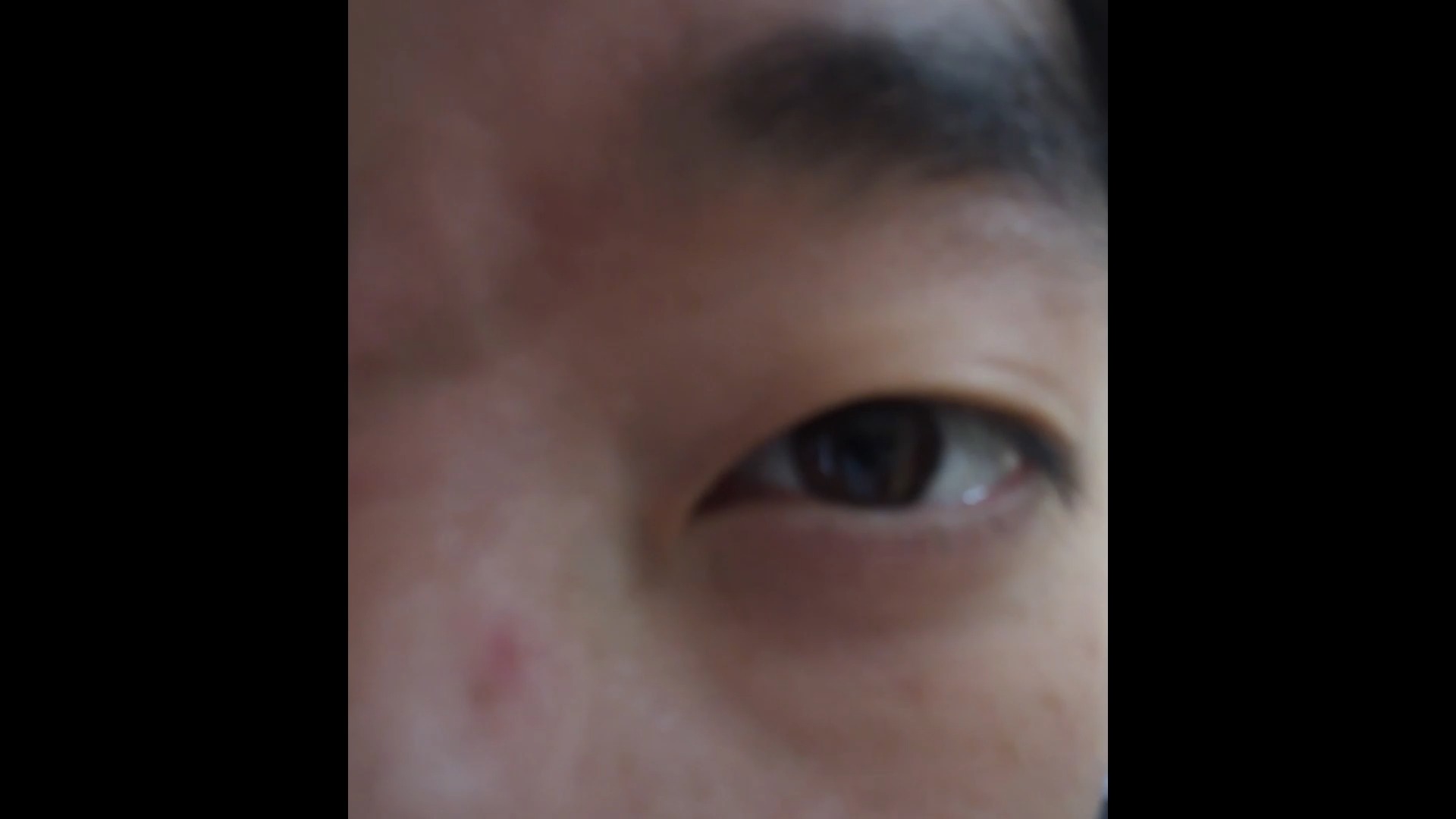 Eye Anomaly Instance Segmentation Dataset by EYETEE