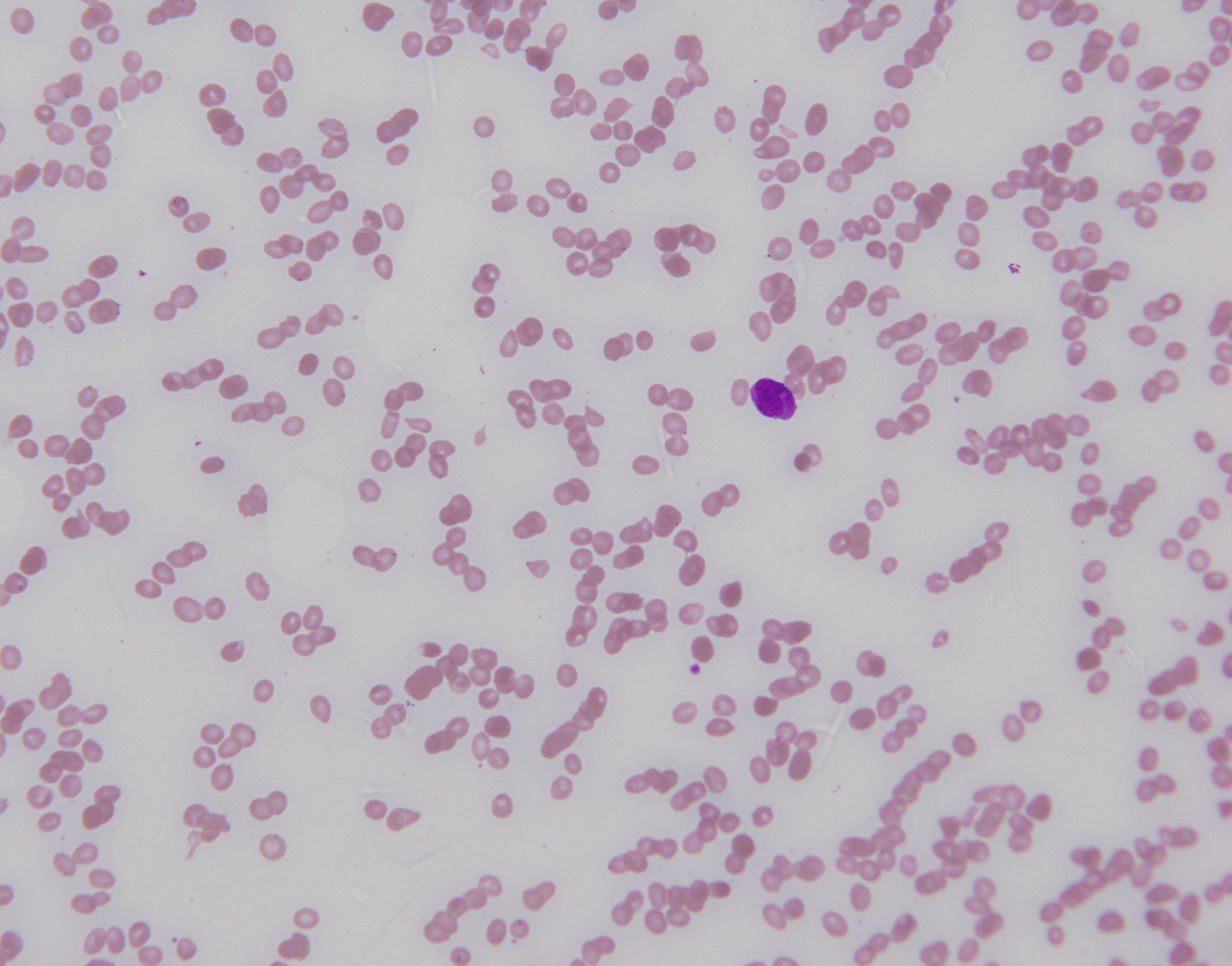 Leukemia Detection2 Object Detection Dataset By Zheng
