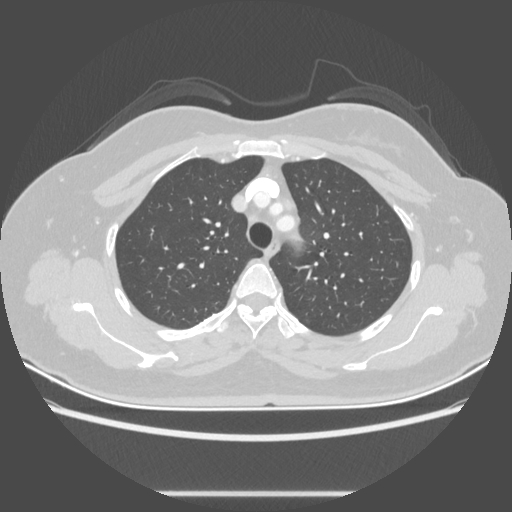 Lung CT Instance Segmentation Dataset and Pre-Trained Model by Johnson Hu