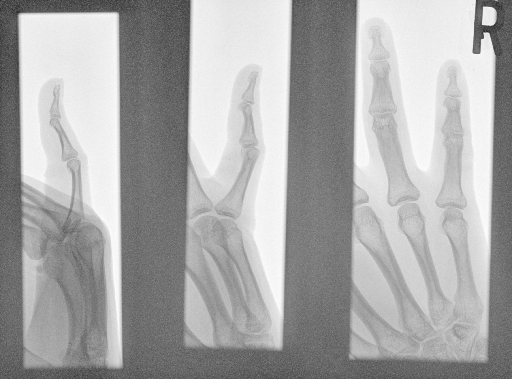 Fraction Detection Object Detection Dataset by fraction detection