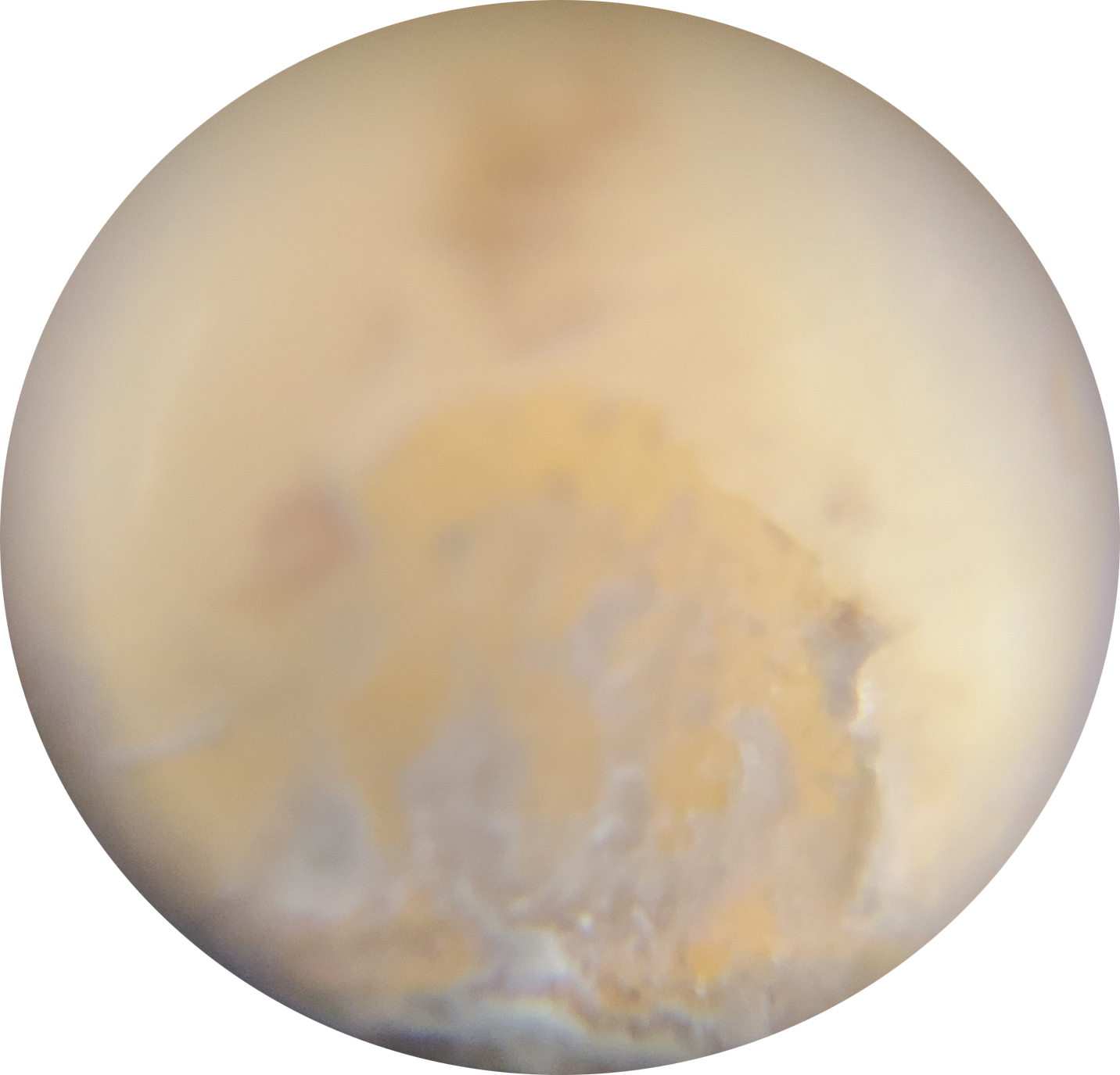 Tooth Cavitation Object Detection Dataset By Helmet Detection