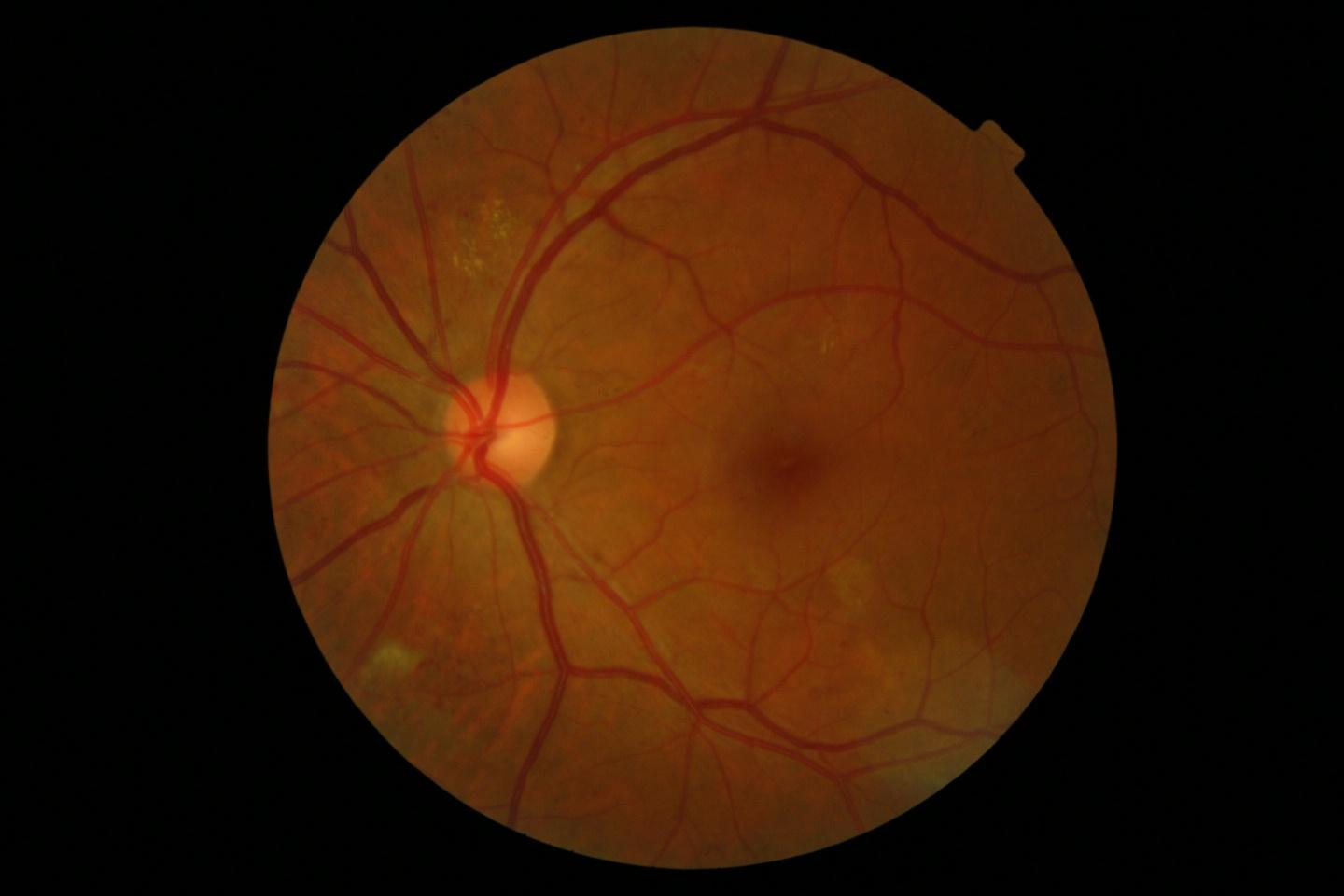 Optic Disc detection Object Detection Dataset by Zahraa Optic Disc detection Object Detection Dataset by Zahraa
